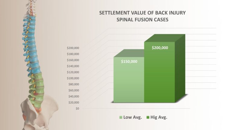 Average Settlement for Spinal Fusion | Compensation Payouts