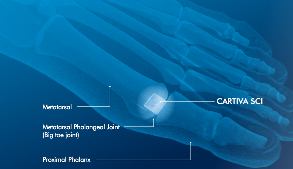 Cartiva Implant Lawsuit